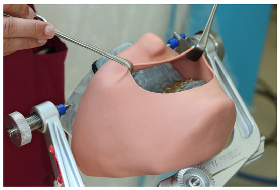 First-Hand Experience and Result with New Robot-Assisted Laser LeFort-I ...