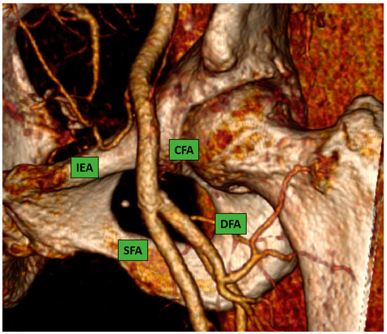 Management of Vascular Access in the Setting of Percutaneous Mechanical ...