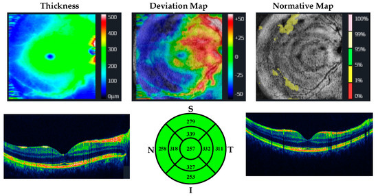 OCT Findings in Patients with Methamphetamine Use Disorder