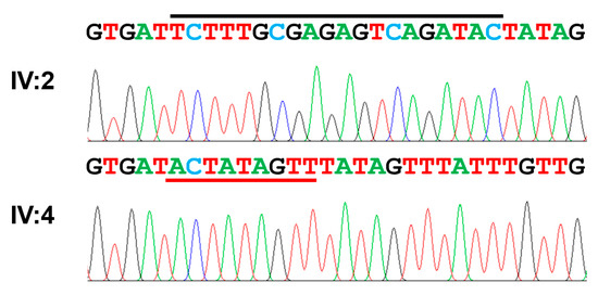 Novel WDR72 Mutations Causing Hypomaturation Amelogenesis Imperfecta
