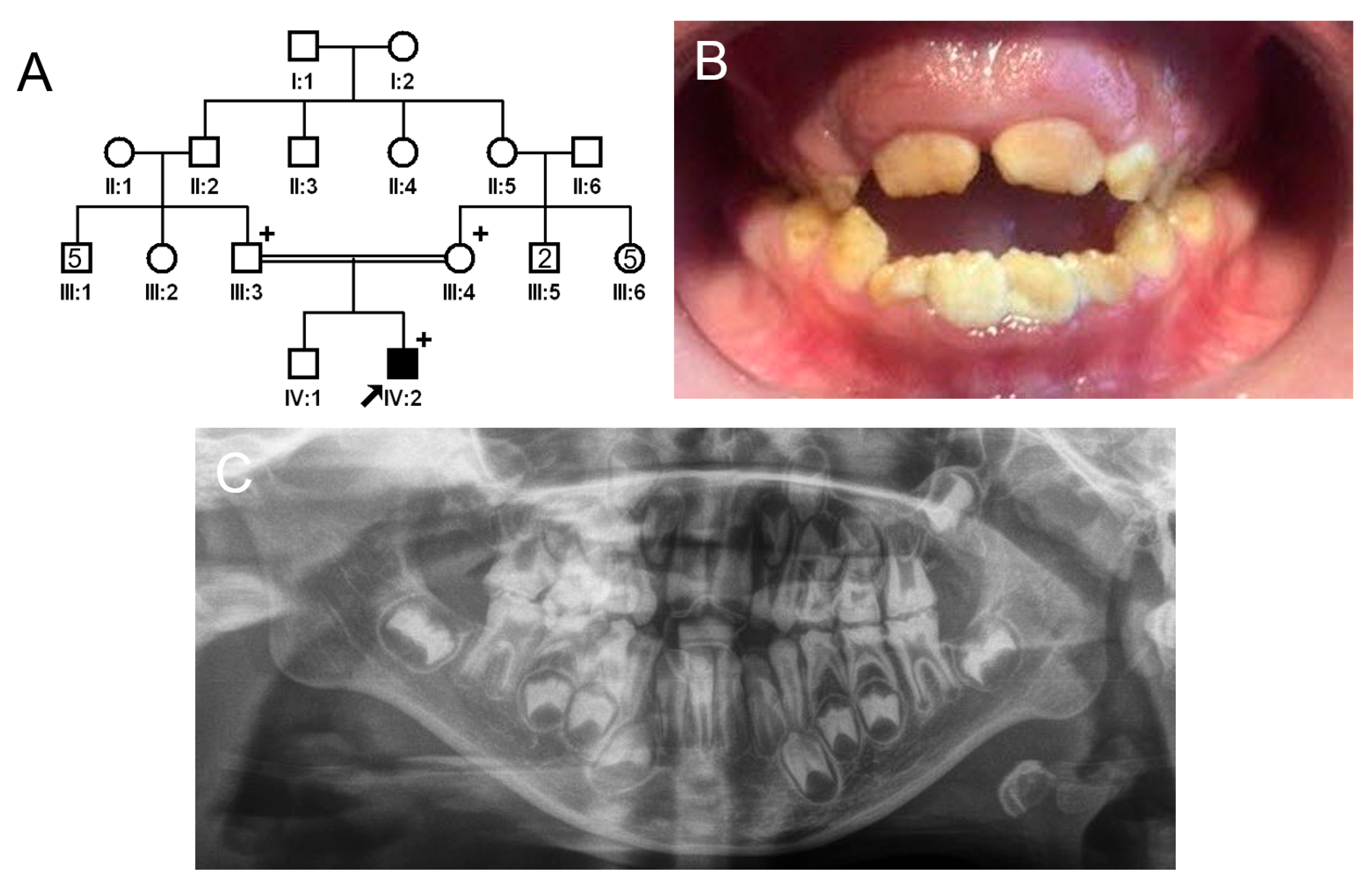 Novel WDR72 Mutations Causing Hypomaturation Amelogenesis Imperfecta
