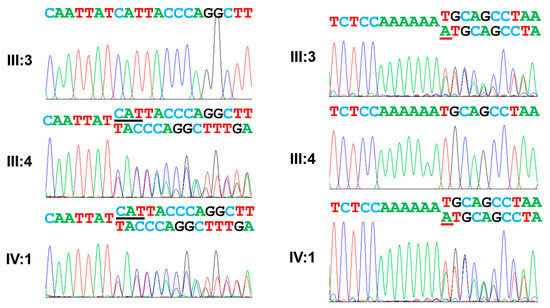 Novel WDR72 Mutations Causing Hypomaturation Amelogenesis Imperfecta