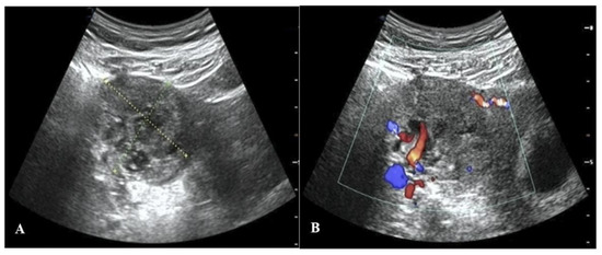 Successful Ultrasound-Guided Methotrexate Intervention in the Treatment ...