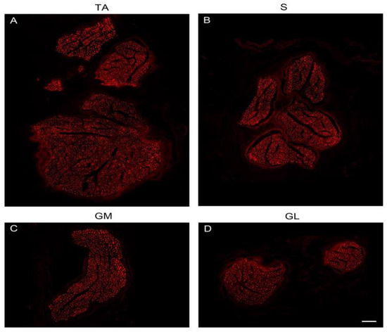 Distal Nerve Transfers in High Peroneal Nerve Lesions: An Anatomical ...