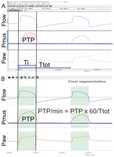Neural Network-Enabled Identification of Weak Inspiratory Efforts ...