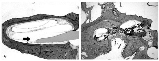 Archival Human Temporal Bone: Anatomical and Histopathological Studies ...