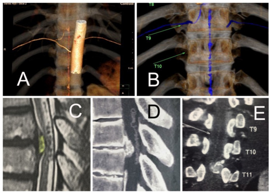 Identification of the Magna Radicular Artery Entry Foramen and ...