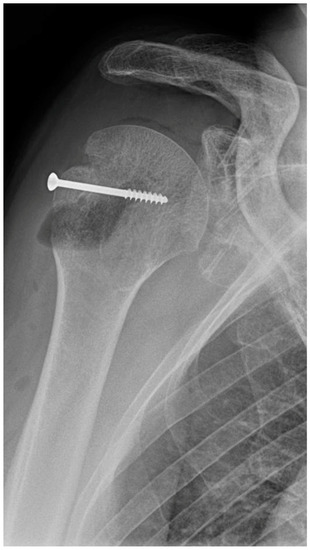 High Complication Rate and High Percentage of Regressing Radiolucency ...