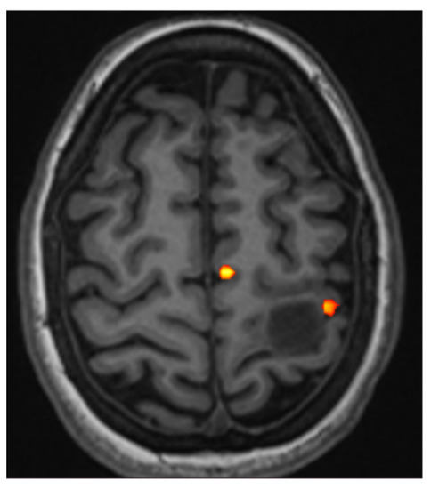 Task-Based and Resting-State Functional MRI in Observing Eloquent ...