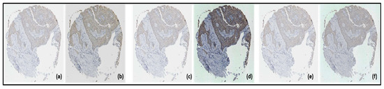 Automated Lung Cancer Segmentation in Tissue Micro Array Analysis ...