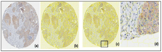 Automated Lung Cancer Segmentation in Tissue Micro Array Analysis ...