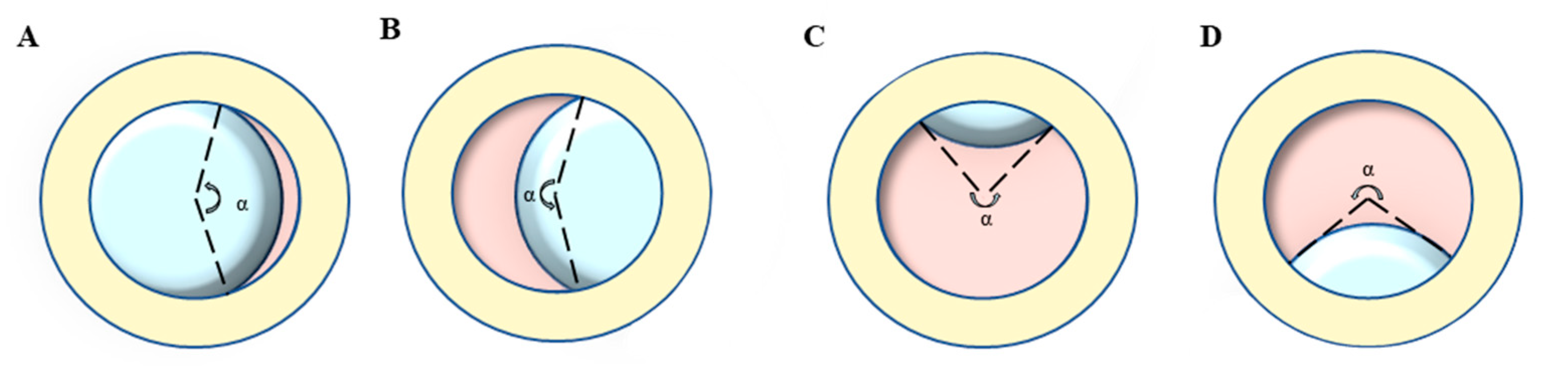 What Should We Pay More Attention to Marfan Syndrome Expecting Ectopia ...