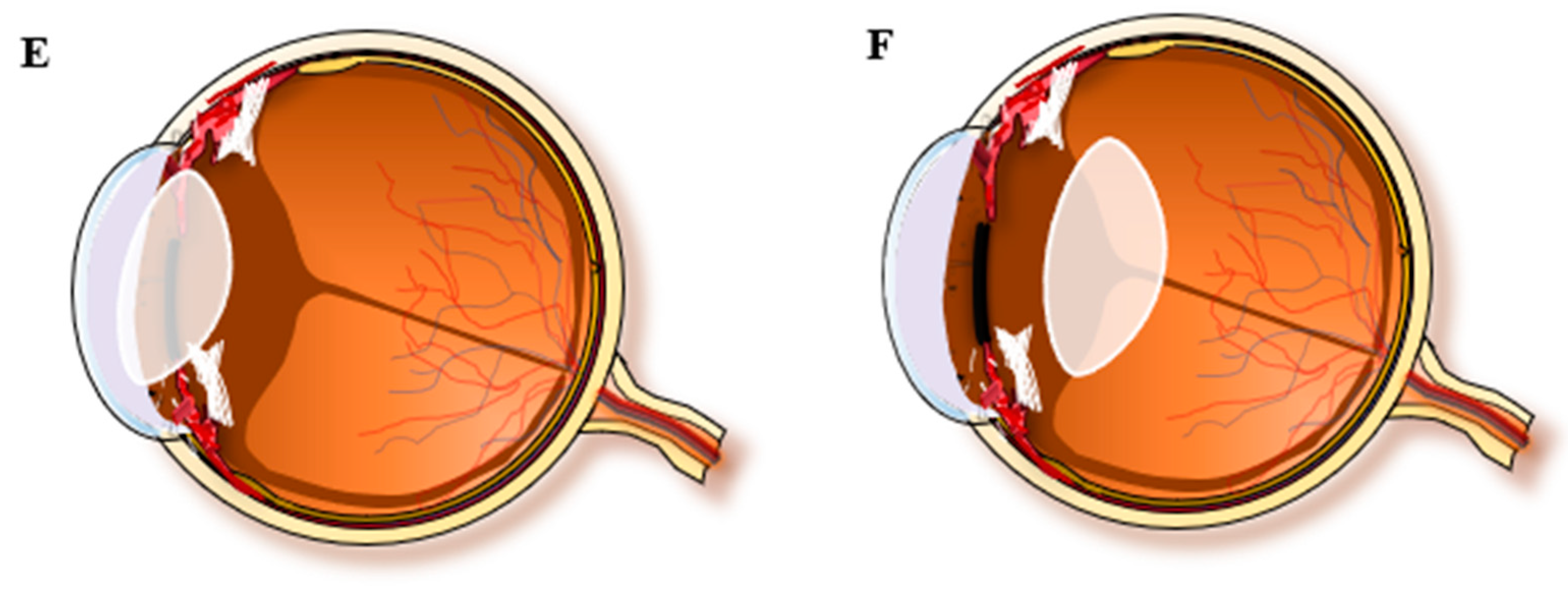 What Should We Pay More Attention to Marfan Syndrome Expecting Ectopia ...