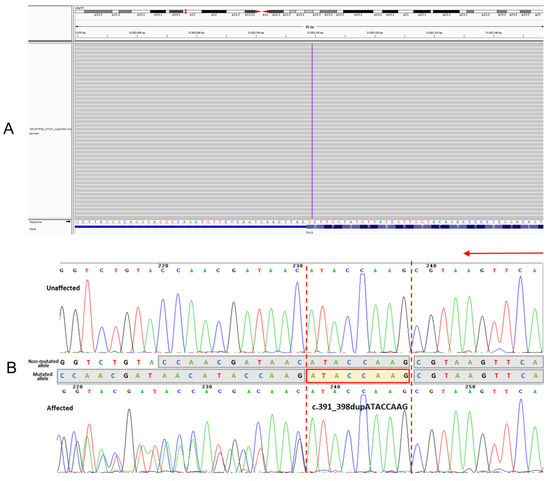JPM | Free Full-Text | A Novel PAX6 Frameshift Mutation Identified in a ...