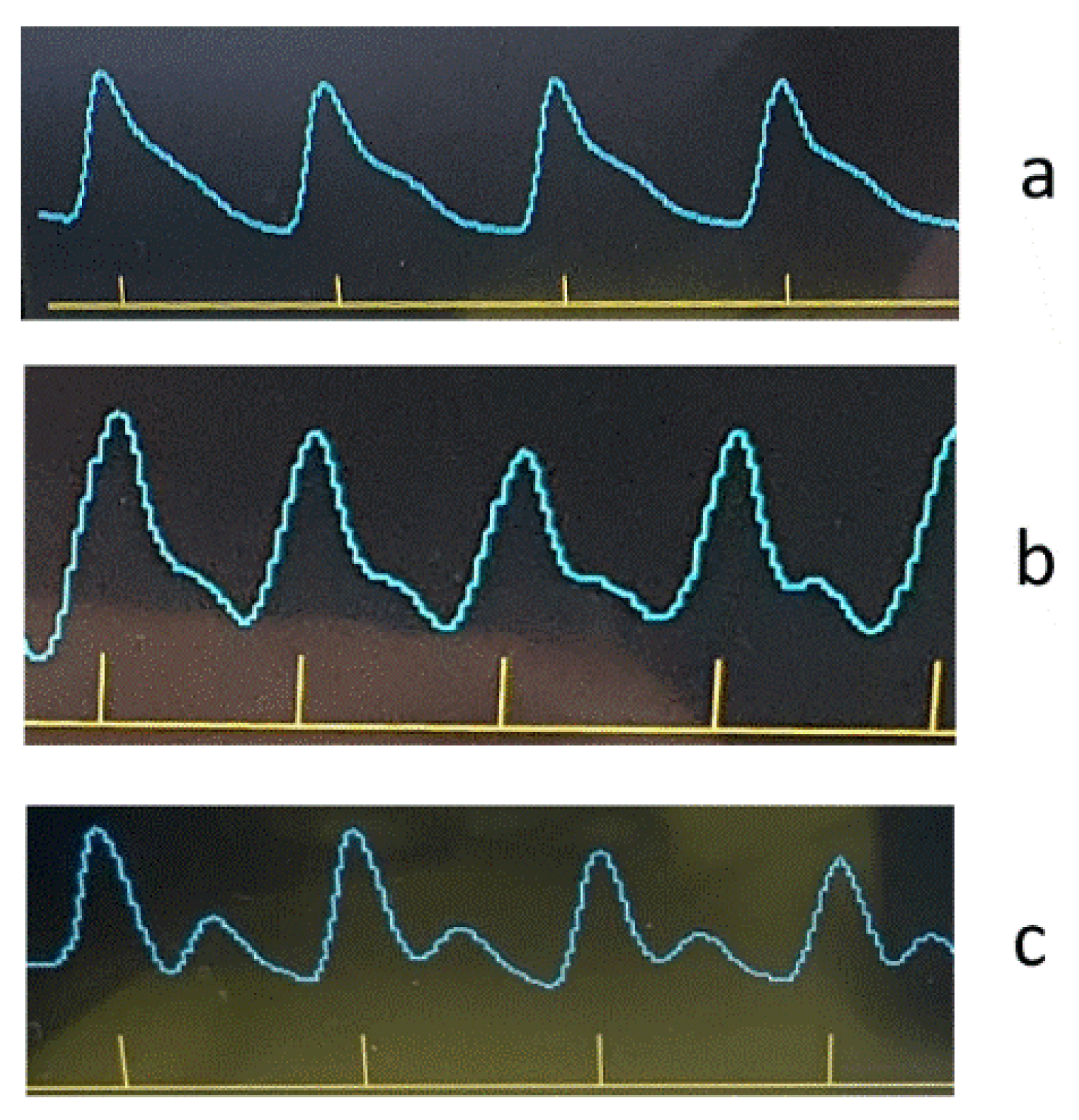 New Methodology of Human Health Express Diagnostics Based on Pulse Wave ...
