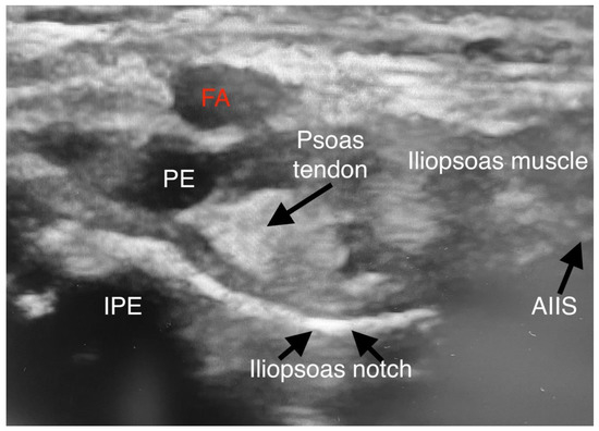 Pericapsular Nerves Group (PENG) Block in Children under Five Years of ...