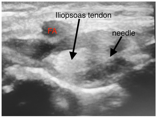 Pericapsular Nerves Group (PENG) Block in Children under Five Years of ...