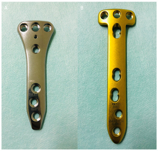 Clinical Outcome after Medial Open-Wedge High Tibial Osteotomy ...