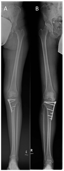 Clinical Outcome after Medial Open-Wedge High Tibial Osteotomy ...
