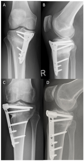 Clinical Outcome after Medial Open-Wedge High Tibial Osteotomy ...