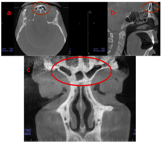 Contribution of Morphology of Frontal Sinuses (Linear and Volumetric ...