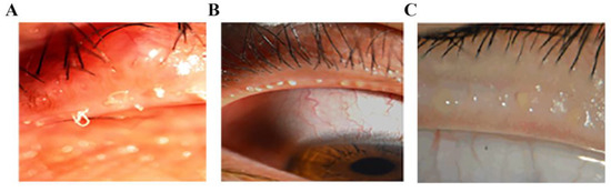 TIPE2 Inhibits MGD Inflammation by Regulating Macrophage Polarization