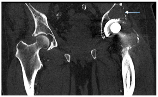 Comparison of the Accuracy of 2D and 3D Templating for Revision Total ...