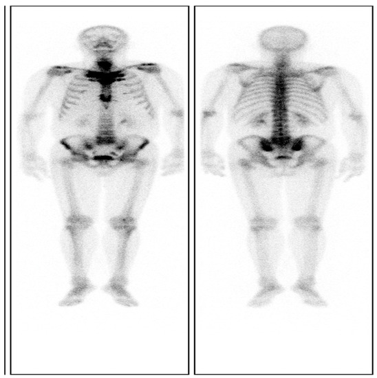 Successful Treatment of SAPHO Syndrome Complicated with Ankylosing ...