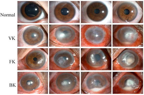 Automatic Diagnosis of Infectious Keratitis Based on Slit Lamp Images Analysis
