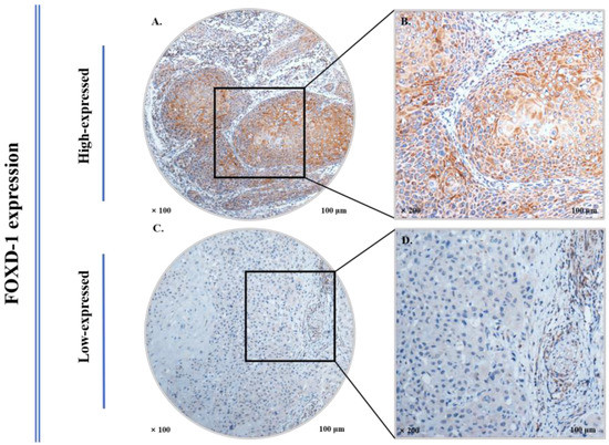 The Prognostic Significance of FOXD1 Expression in Head and Neck ...