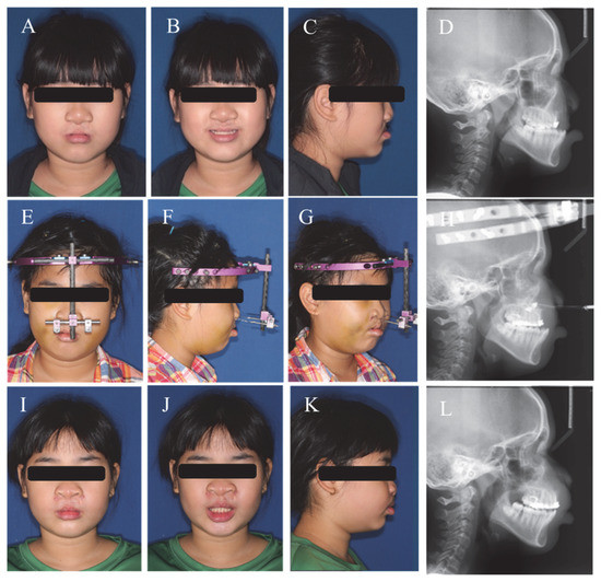 Assessing the Impact of Transcutaneous Maxillary Distraction Osteogenesis on Pharyngeal Airway ...