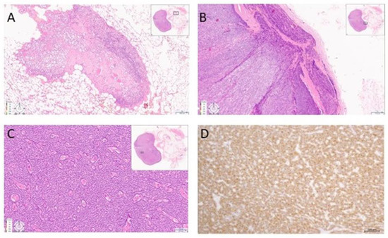 Multiple Metastases of Parathyroid and Papillary Thyroid Carcinoma in a ...