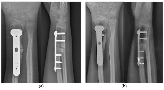The Flipping-Wedge Osteotomy: How 3D Virtual Surgical Planning (VSP ...