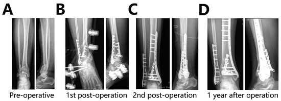 Early Reduction of the Posterior Column: A Surgical Technique in AO/OTA ...