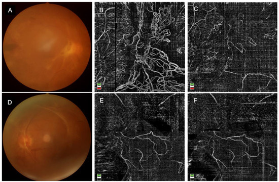 Effect of Intravitreal Conbercept Injection on Complications of Pars ...