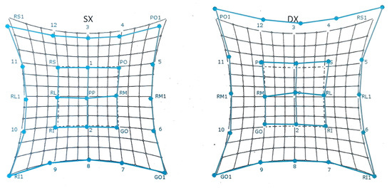 Patient Specific Implants for Orbital Reconstruction in the Treatment ...
