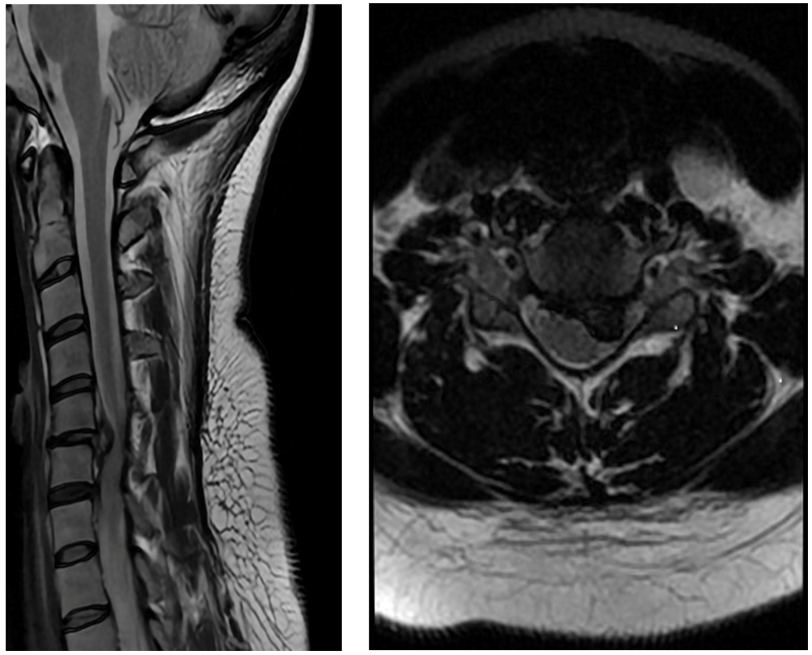 Clinical And Radiological Outcome Of Disc Arthroplasty For The