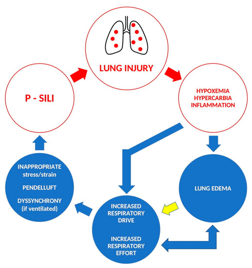 Patient Self-Inflicted Lung Injury—A Narrative Review of ...