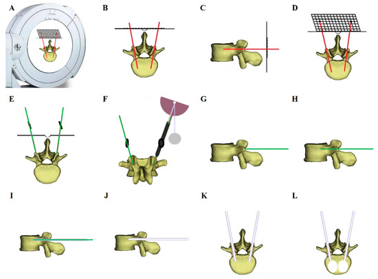O-Arm- and Guide-Device-Assisted Personalized Percutaneous Kyphoplasty ...