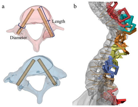 Clinical Application of Personalized Digital Surgical Planning and ...