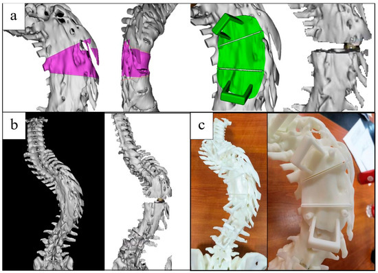 Clinical Application of Personalized Digital Surgical Planning and ...