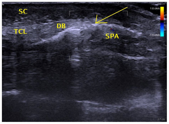 Early Postoperative Recovery after Modified Ultra-Minimally Invasive ...