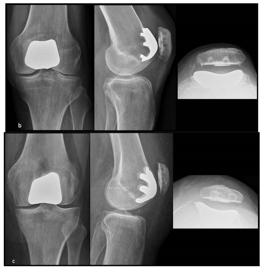 Patellofemoral Arthroplasty Is an Efficient Strategy for Isolated ...