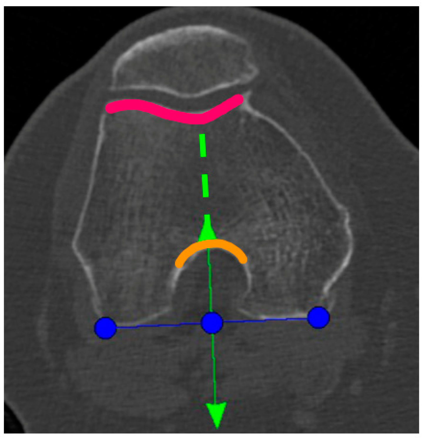 Setting the Tibial Component Rotation Based on Femoral Landmarks Allows ...