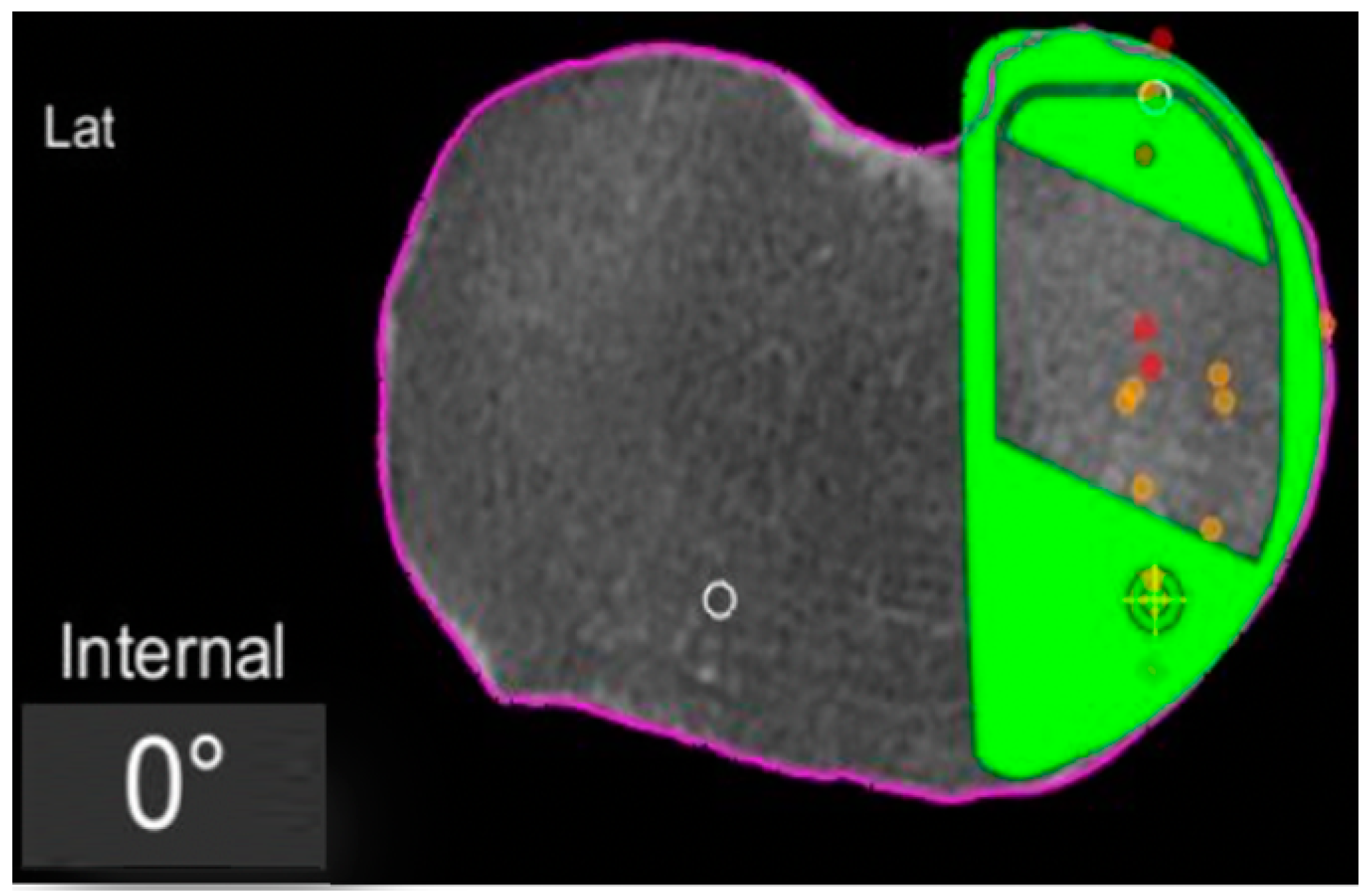 Setting the Tibial Component Rotation Based on Femoral Landmarks Allows ...