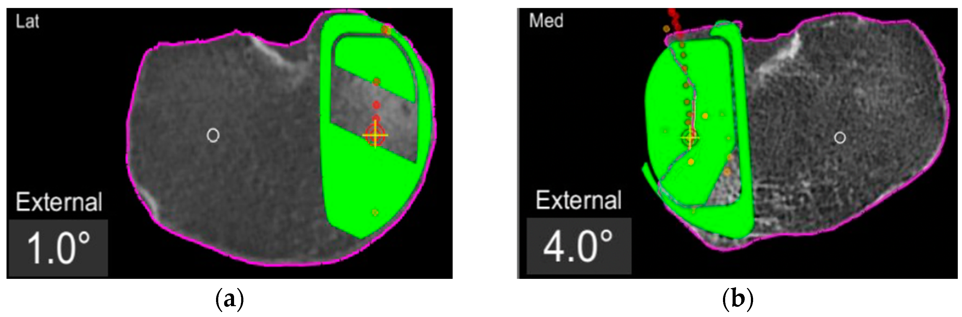 Setting the Tibial Component Rotation Based on Femoral Landmarks Allows ...