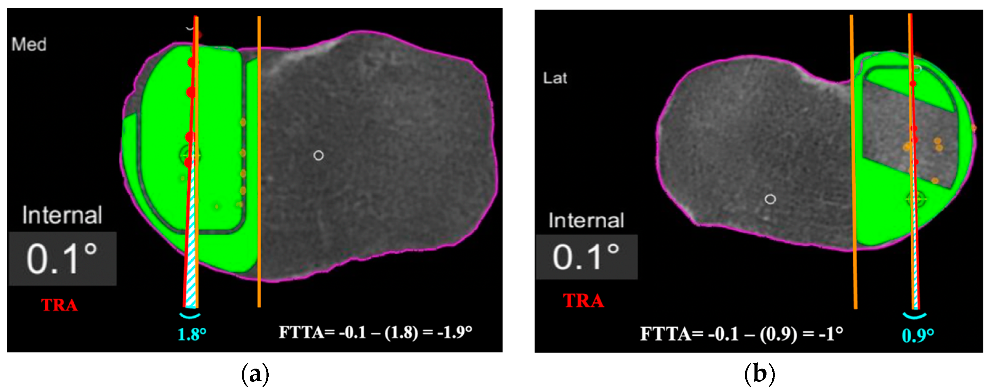 Setting the Tibial Component Rotation Based on Femoral Landmarks Allows ...