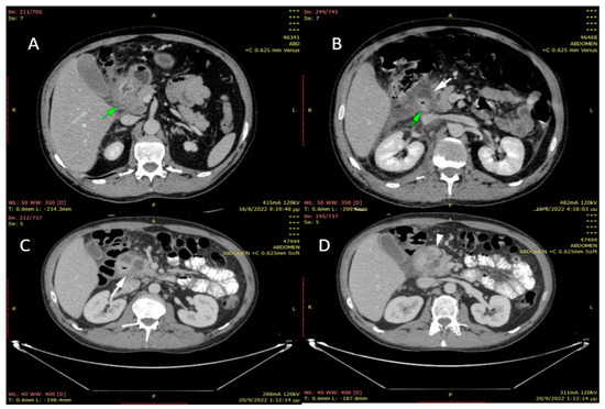 Surgical Management of Groove Pancreatitis: A Case Report