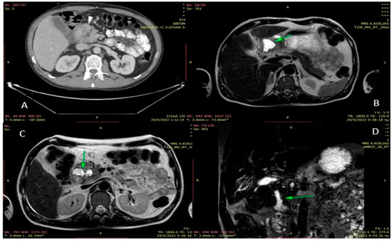 Surgical Management of Groove Pancreatitis: A Case Report
