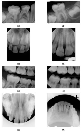 Radiation Exposure and Frequency of Dental, Bitewing and Occlusal Radiographs in Children and ...